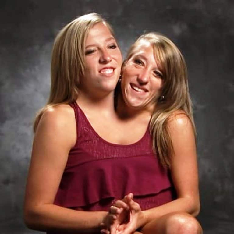 10 Most Famous Siamese Twins In The World And Their Lives Ke