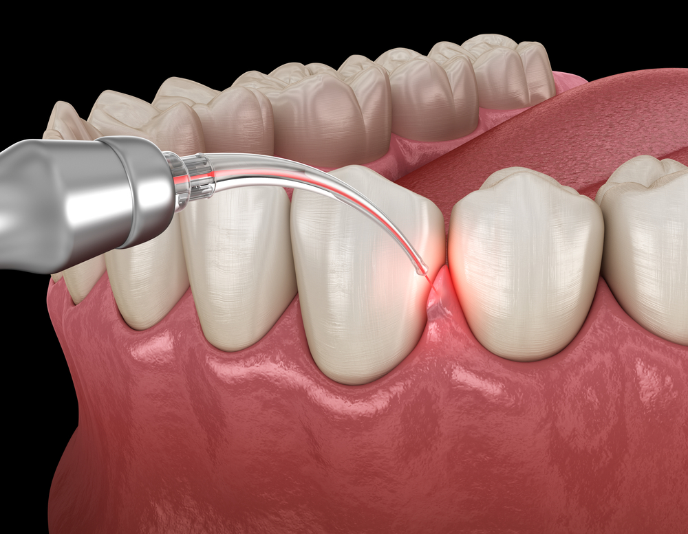 Gum Disease Laser Lanap Treatment Orange Park