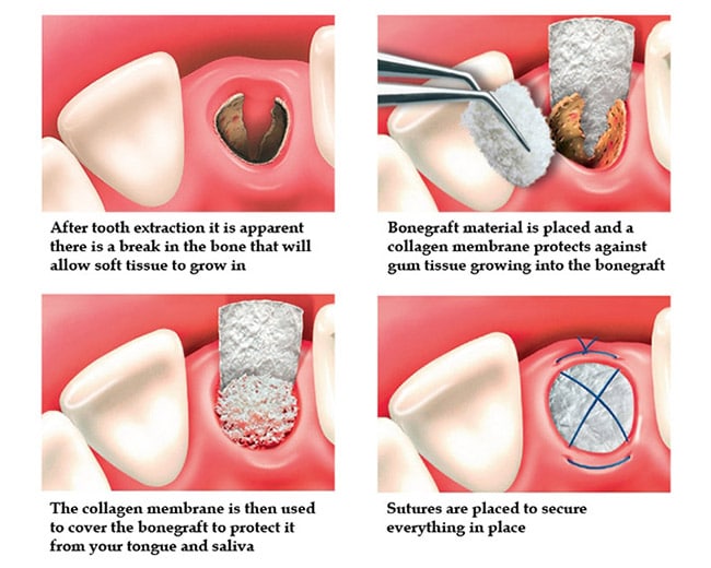 Wisdom Teeth Stitches Fall Out