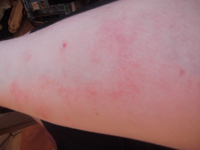 What Causes Itchy Rash All Over Body New Health Advisor