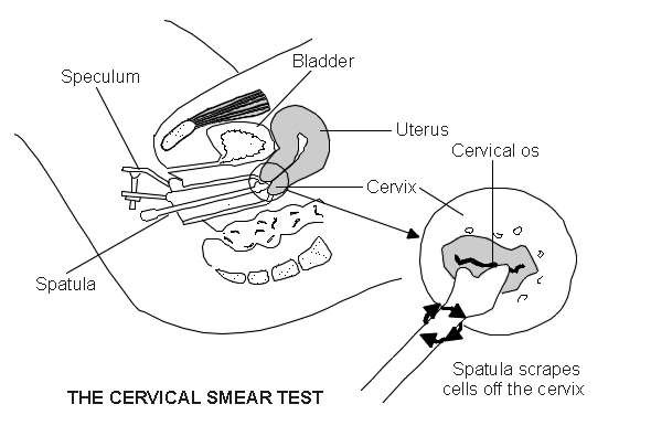 Cervical Smear Diagram Patient