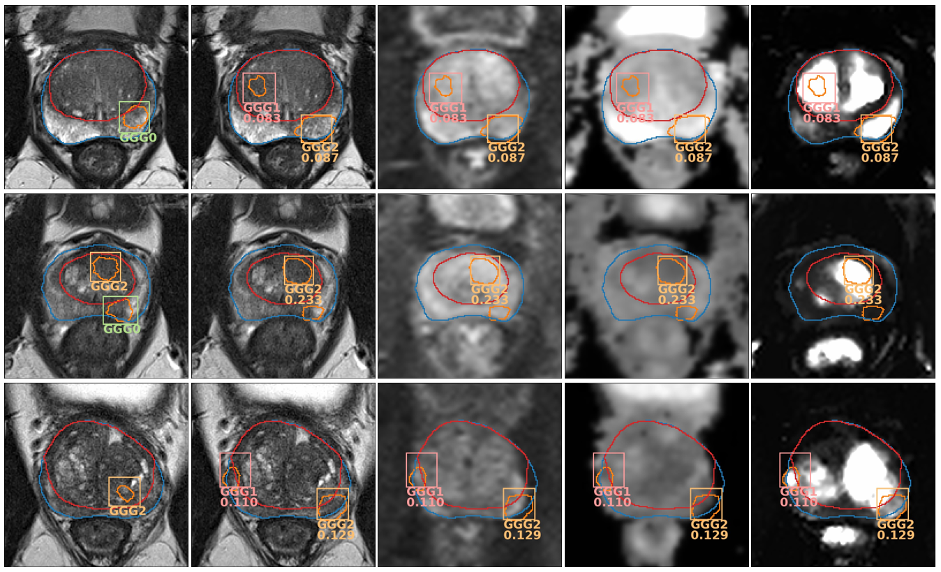 Deep Learning For Fully Automatic Detection Segmentation And Gleason